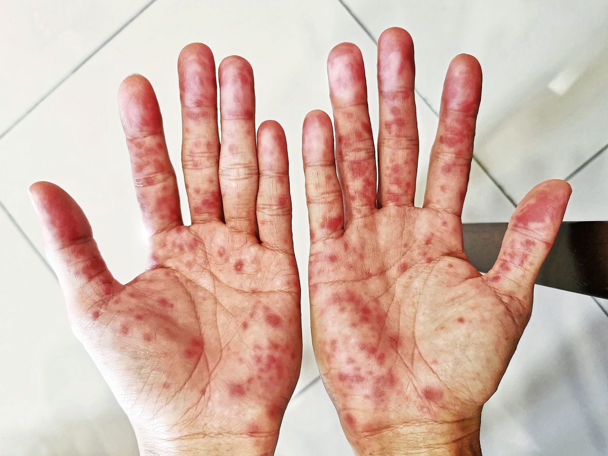 Johor records increase in HMFD cases, says health exco | The Star