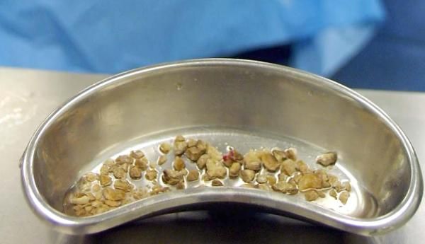 A dietary resolution to stop kidney stones | The Star