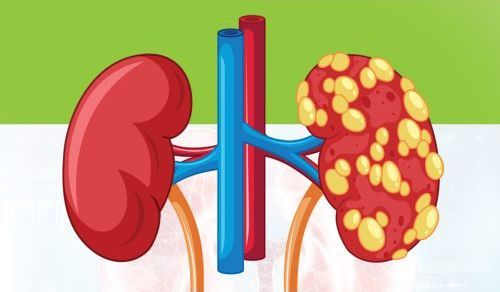 Rise in chronic kidney disease | The Star