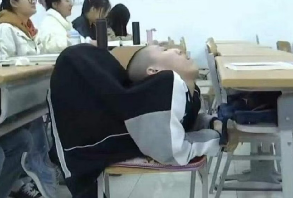 ‘Folded boy’ starts surgery in hopes of standing straight for first ...