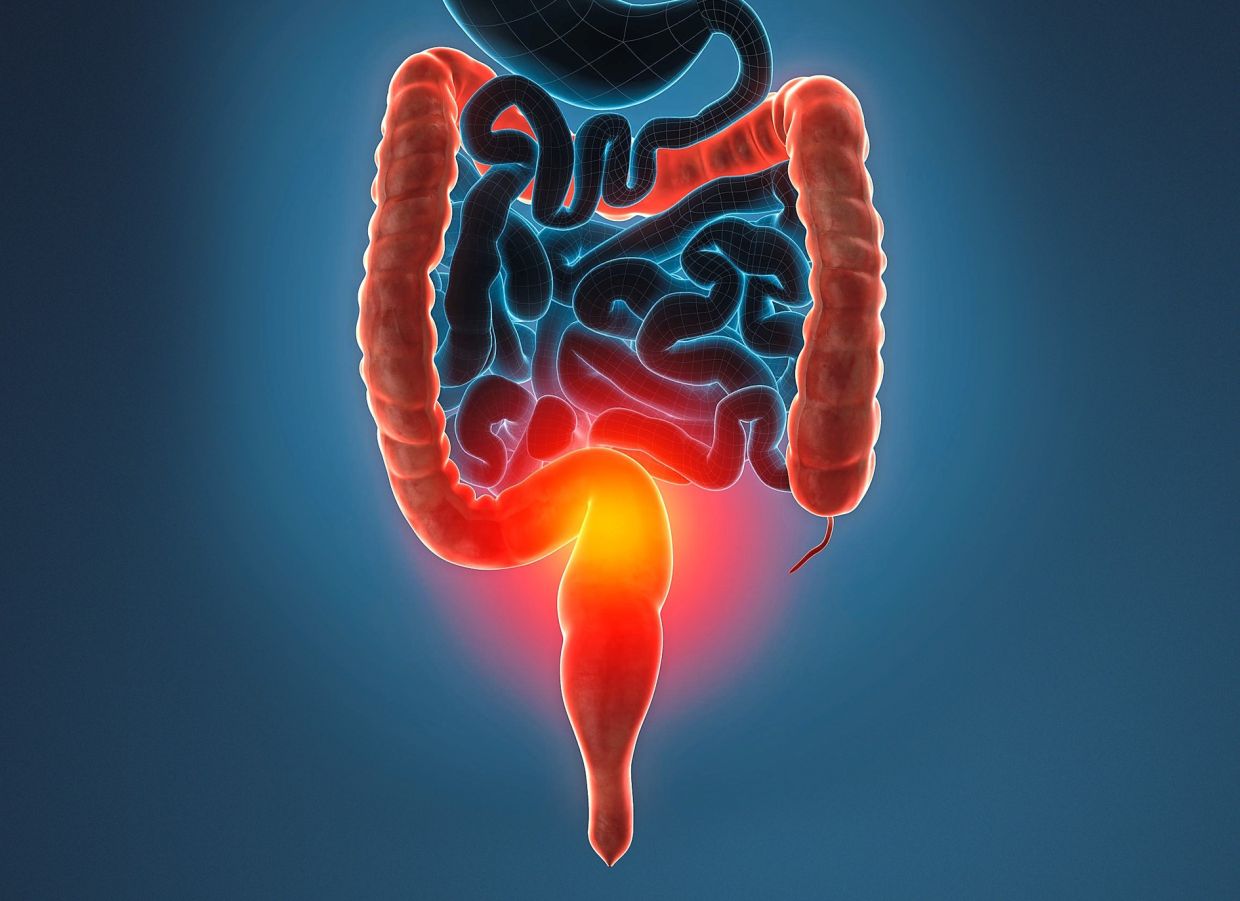 Young adults, beware of colorectal cancer | The Star