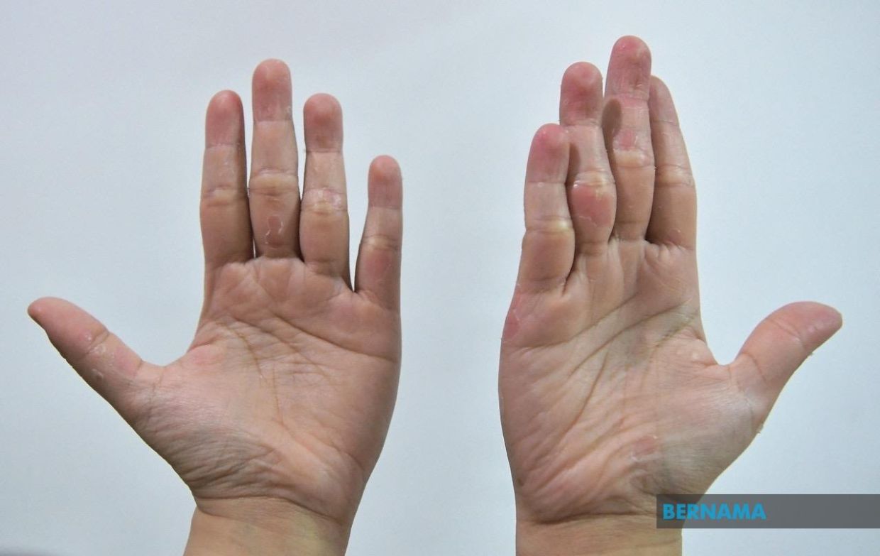 Vietnam raises guard and take major steps against rising hand, foot and ...