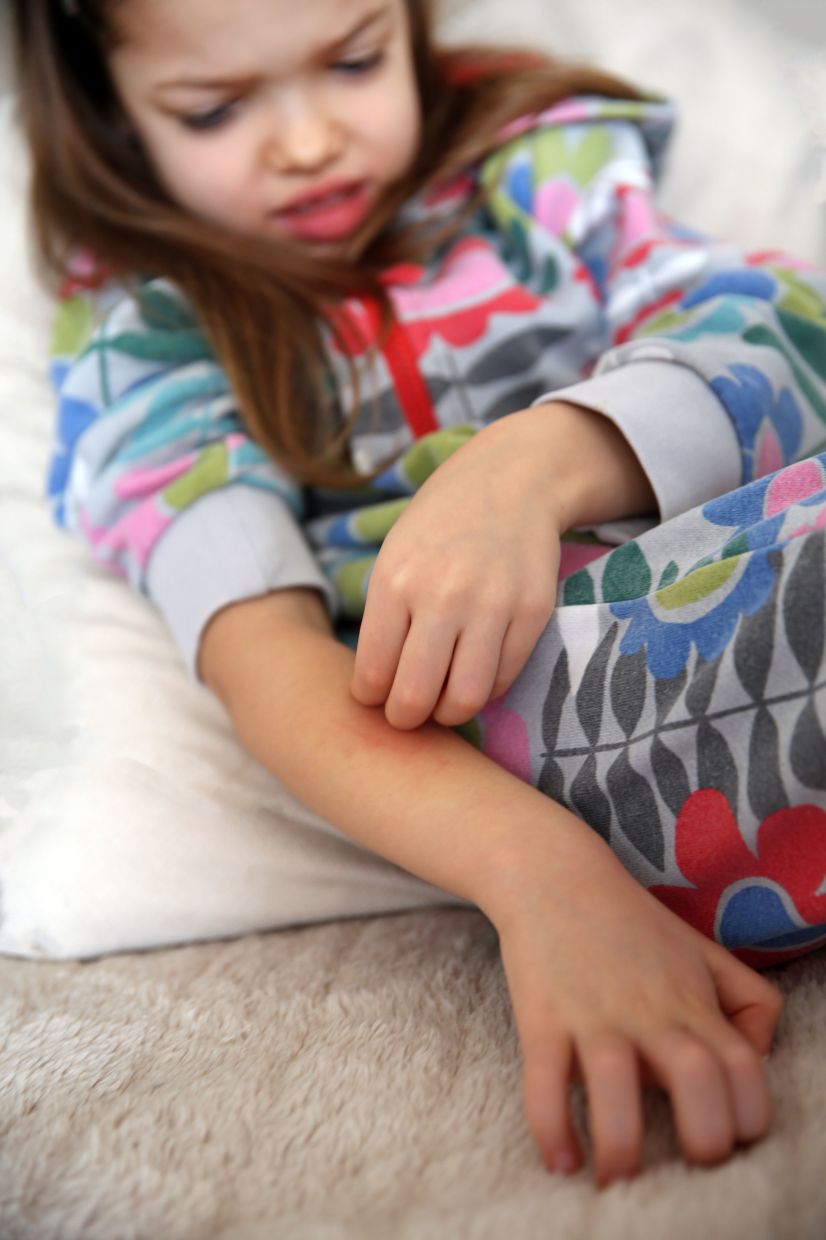 Five possible causes for your child's rash | The Star