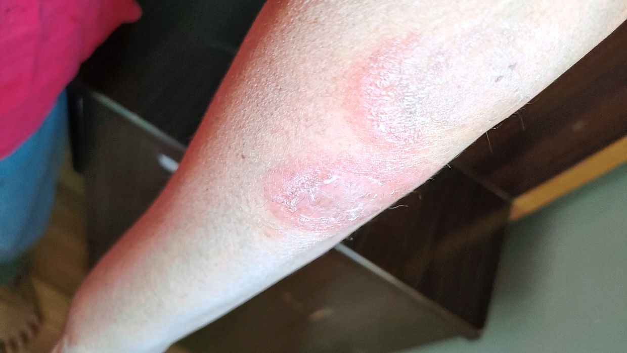 Pustules, rashes, pain... generalised pustular psoriasis is hard to ...