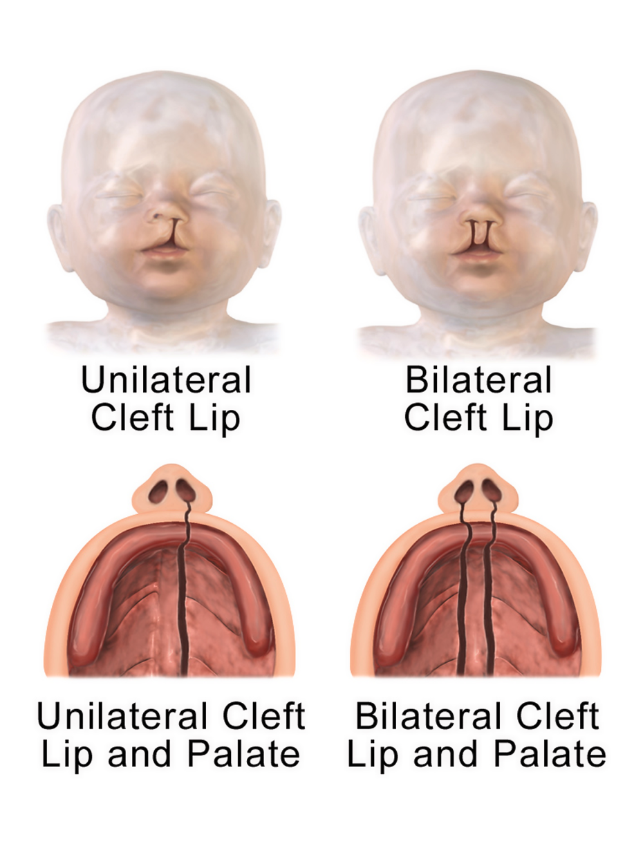 Helping Malaysian kids with cleft lip and palate regain function and confidence | The Star