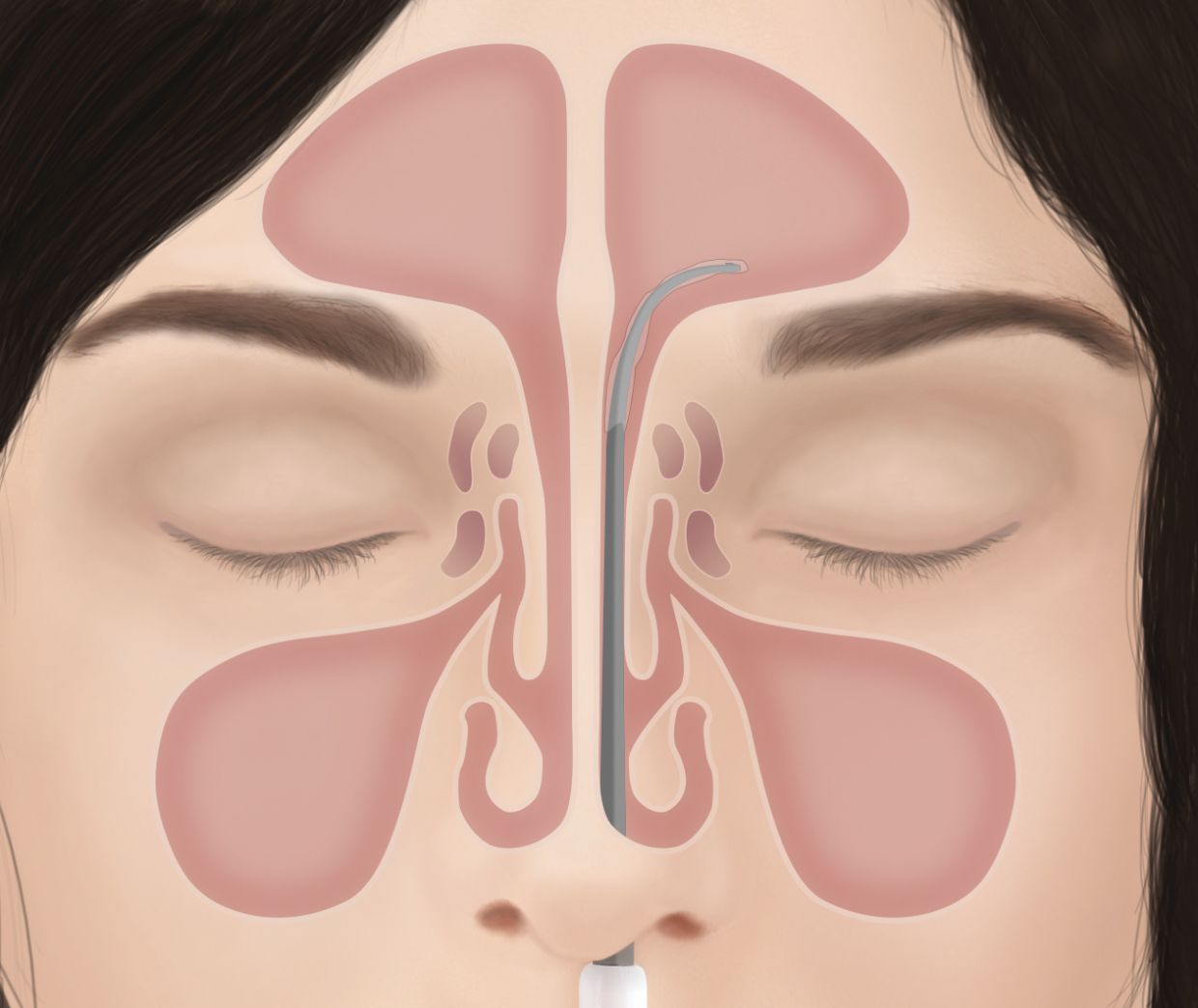 Sorting out chronic sinusitis with a balloon | The Star