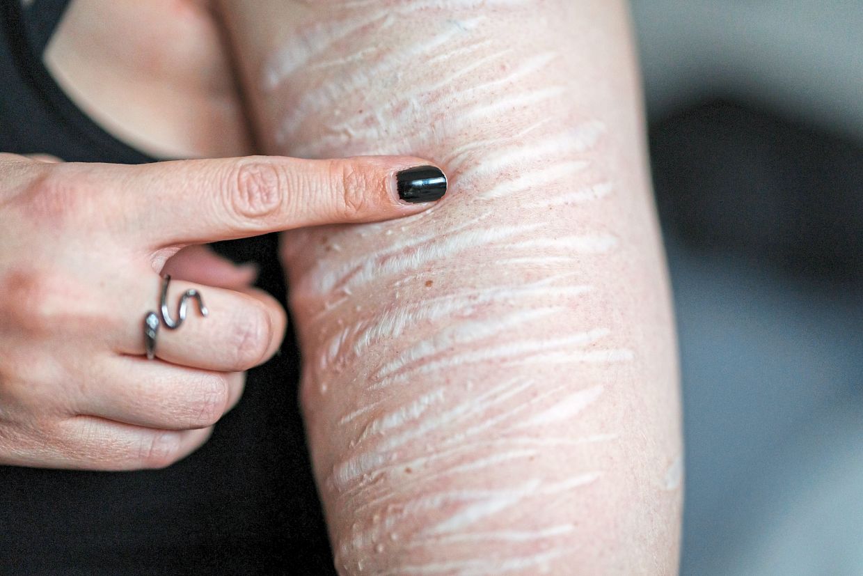 Self Harm Cuts On Thighs