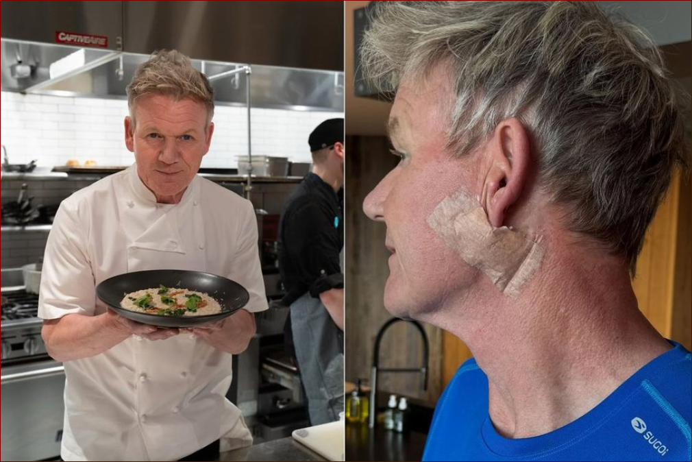 Celebrity chef Gordon Ramsay reveals skin cancer diagnosis, undergoes ...