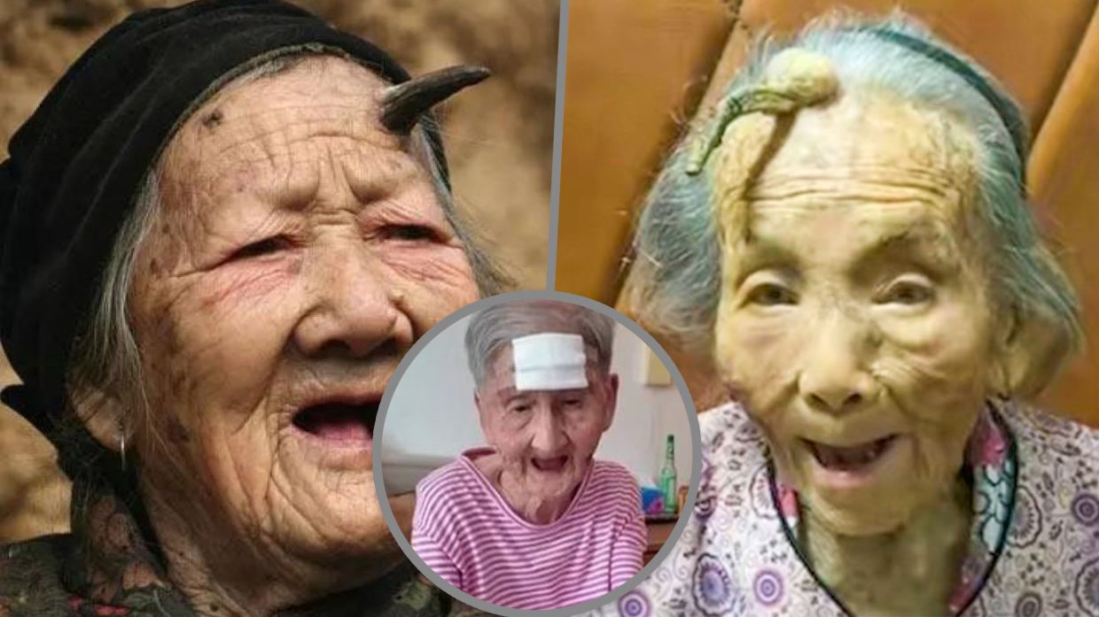 China grandma cuts ‘longevity horn’ off head with scissors; needs ...